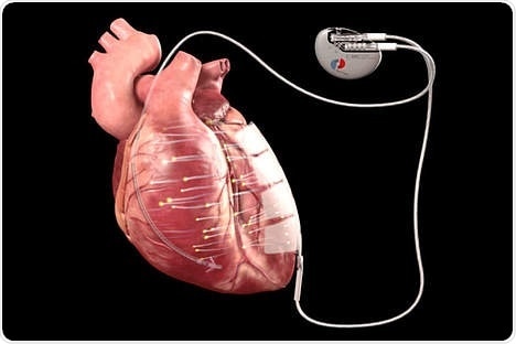 Implanted device uses microcurrent to exercise heart muscle in ...