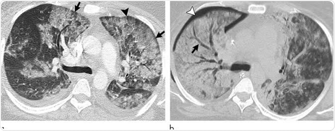 Pulmonary imaging key to diagnosing vaping-related lung damage