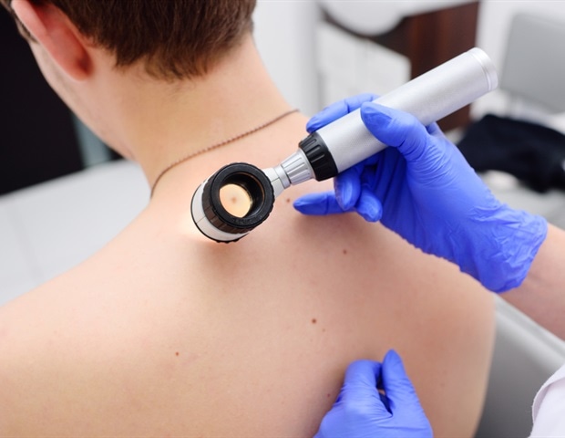 New melanoma test may better predict recurrence and improve patient care