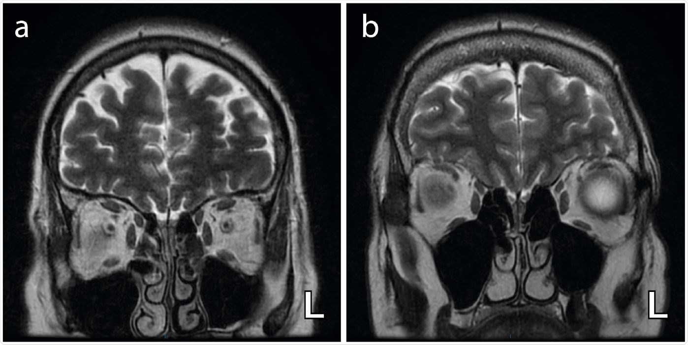 Brain metabolic changes associated with loss of smell in COVID-19