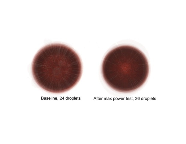 Patterns and cracks from dried blood droplets could indicate specific ...