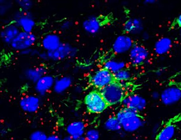 Gene that could affect the progress of ALS discovered