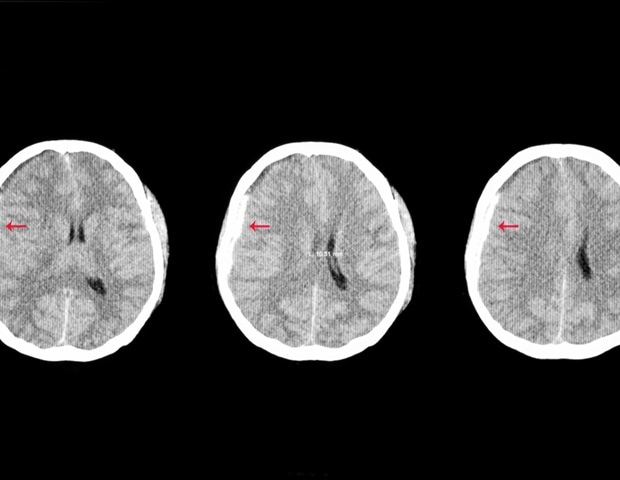 Is Reversing Brain Damage Possible?