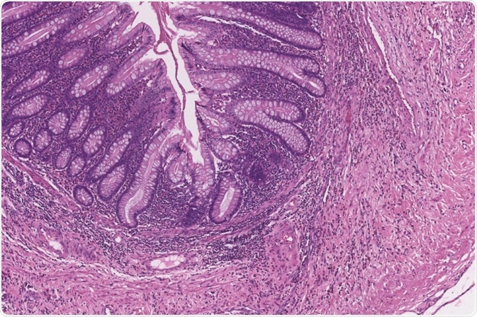 Bowel Preparation for Colectomy: Risks to Watch For