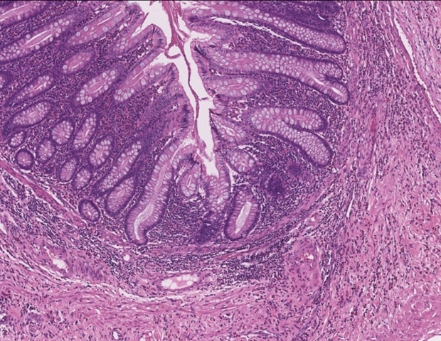 Bowel Preparation for Colectomy: Risks to Watch For