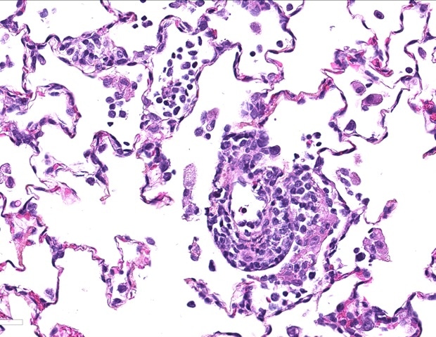 Regeneron antibody cocktail shows promise as potential COVID-19 treatment