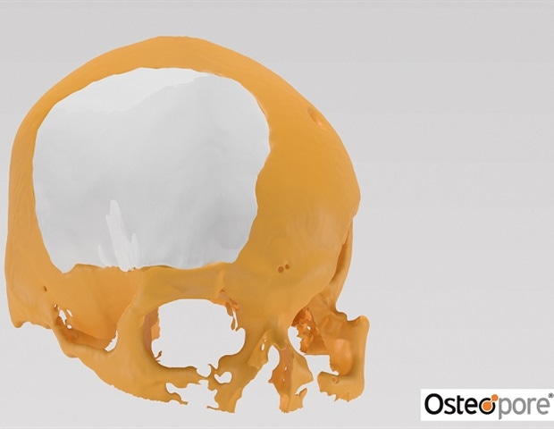 Osteopore announces success of its 3D-printed PCL bone implant in ...