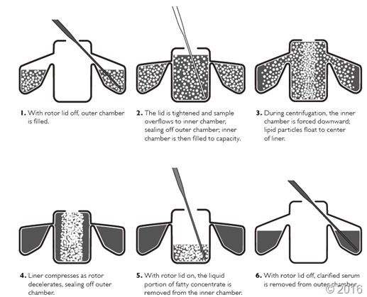 Clarification of Lipemic Serum and Removal of Fatty Particles Using ...