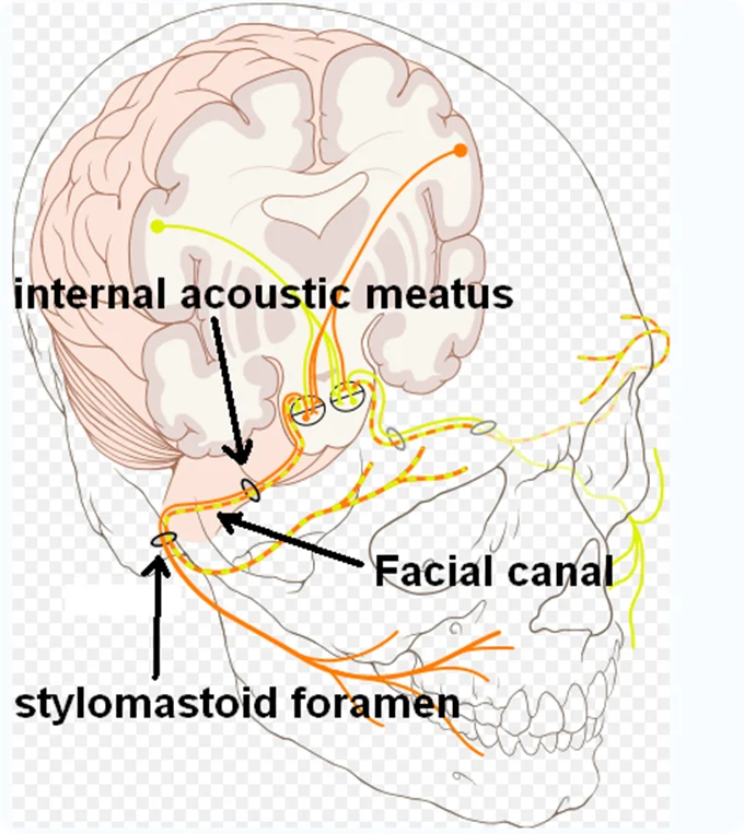 Congenital vs Acquired Facial Palsy