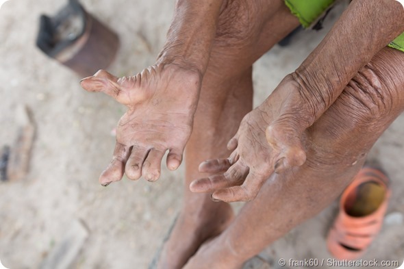 Leprosy Causes
